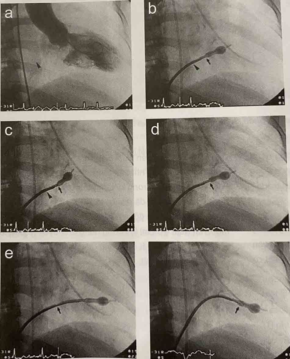 Nong van hai lá bằng bóng ionue thực hiện như thế nào?
